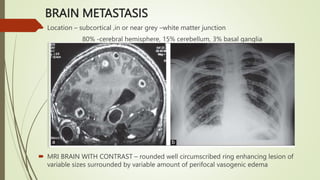 Differential diagnosis for ring enchancing lesion in brain | PPTX