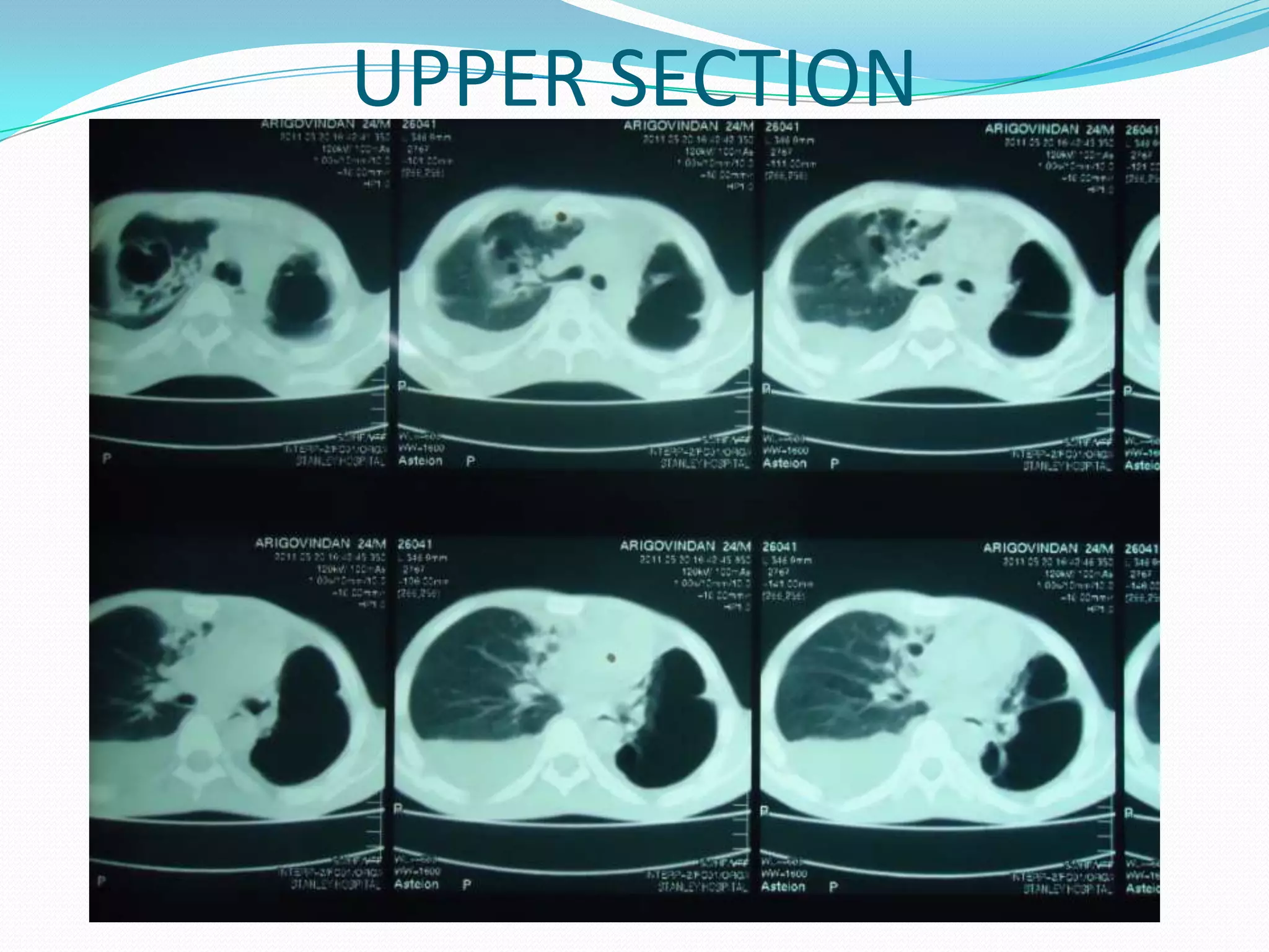 CT Chest: Manifestations of TB | PPT