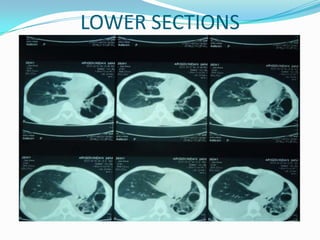 CT Chest: Manifestations of TB | PPTX