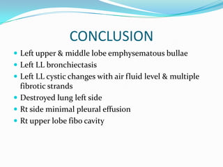 CT Chest: Manifestations of TB | PPT