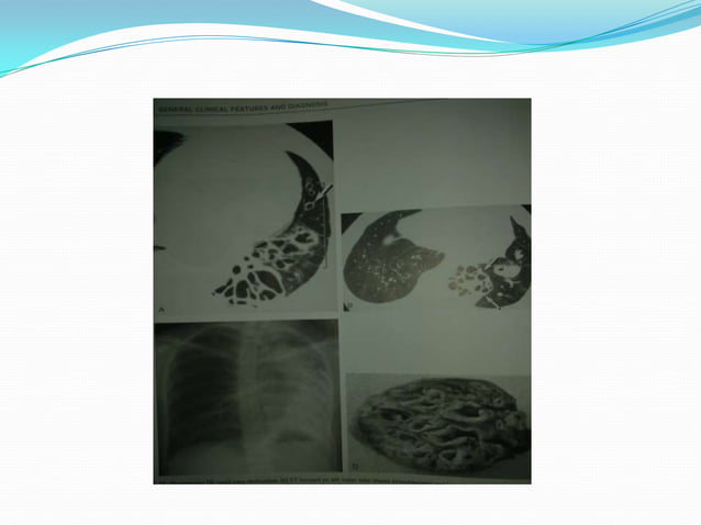 CT Chest: Manifestations of TB | PPT