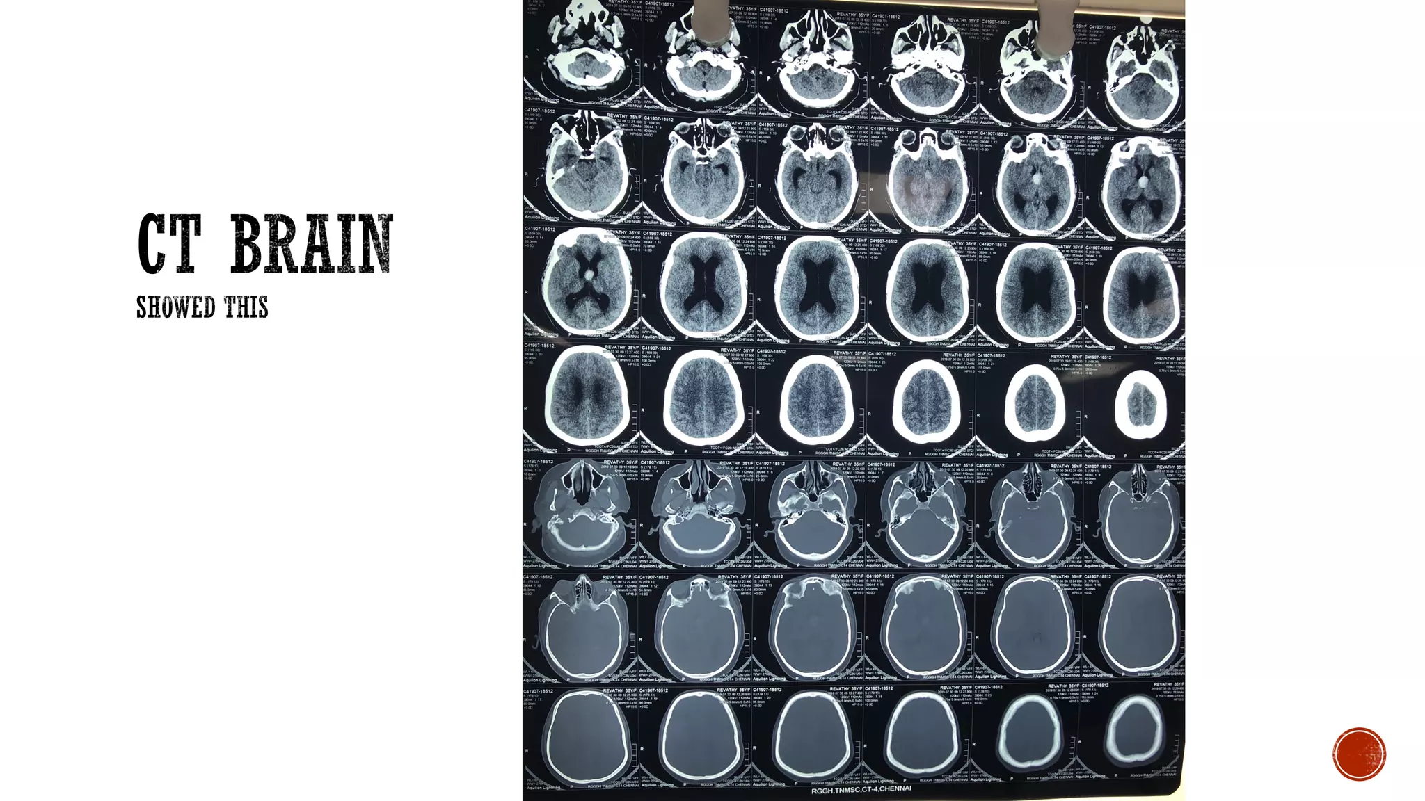 COLLOID CYST OF BRAIN / CNS SPACE OCCUPYING LESIONS - BENIGN | PDF