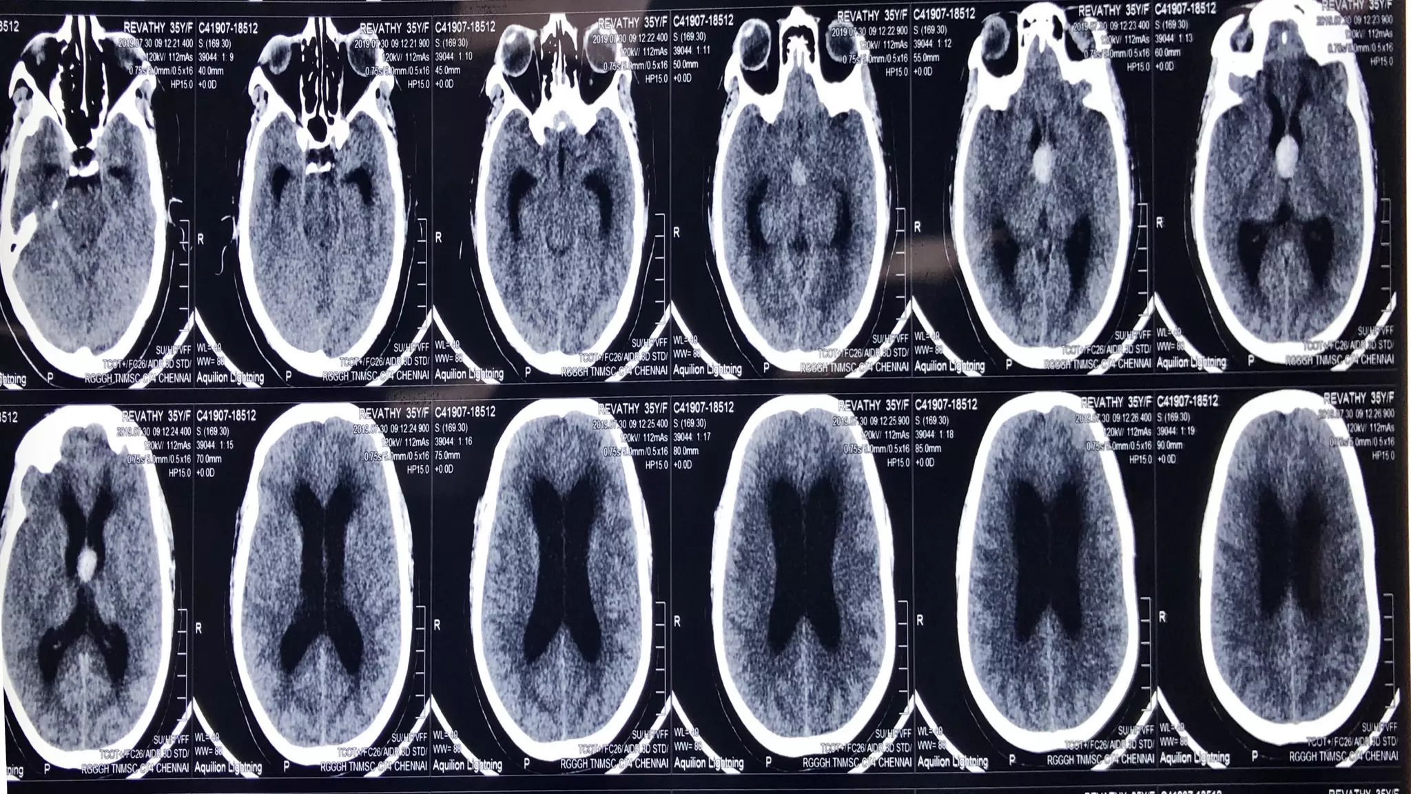 COLLOID CYST OF BRAIN / CNS SPACE OCCUPYING LESIONS - BENIGN | PDF