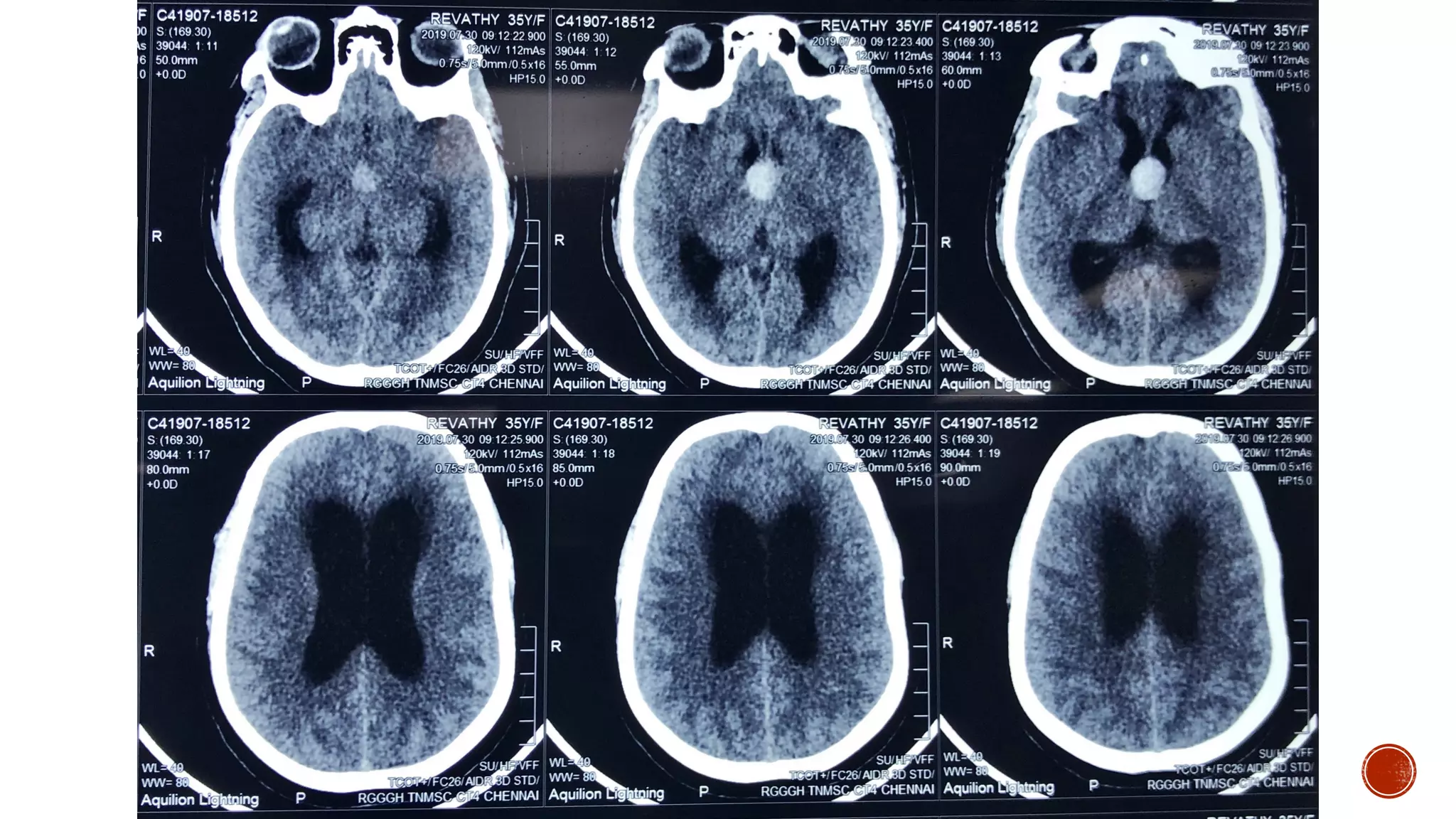 COLLOID CYST OF BRAIN / CNS SPACE OCCUPYING LESIONS - BENIGN | PDF