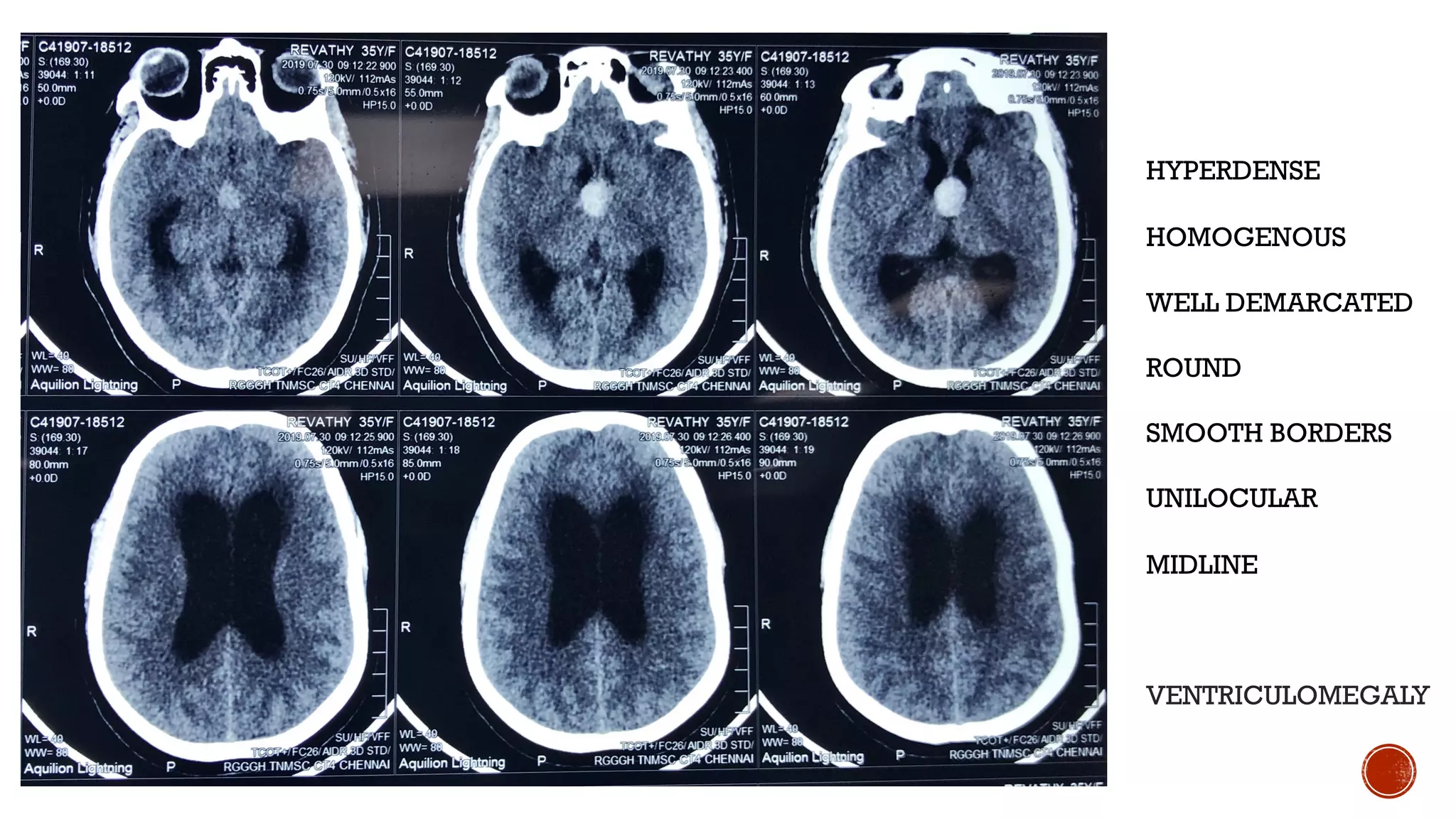 COLLOID CYST OF BRAIN / CNS SPACE OCCUPYING LESIONS - BENIGN | PDF