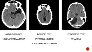 COLLOID CYST OF BRAIN / CNS SPACE OCCUPYING LESIONS - BENIGN
