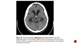 COLLOID CYST OF BRAIN / CNS SPACE OCCUPYING LESIONS - BENIGN
