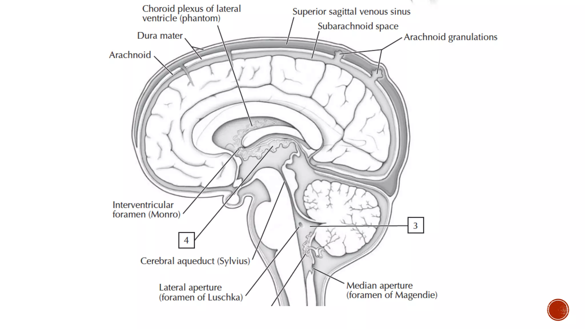 Colloid Cyst - Image of the Week | PPT