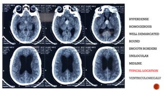 Colloid Cyst - Image of the Week | PDF