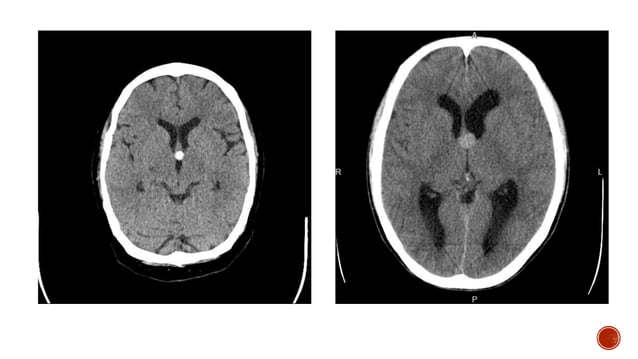 Colloid Cyst - Image of the Week | PPT