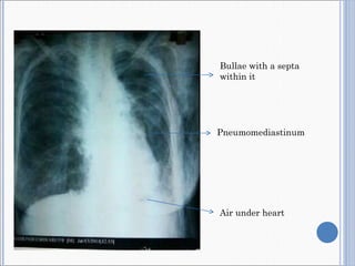 Imaging: Pneumomediastinum/pneumothorax/bullae | PPT