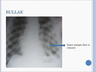 Imaging: Pneumomediastinum/pneumothorax/bullae | PPT