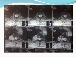 MRI: Cord Compression | PPT