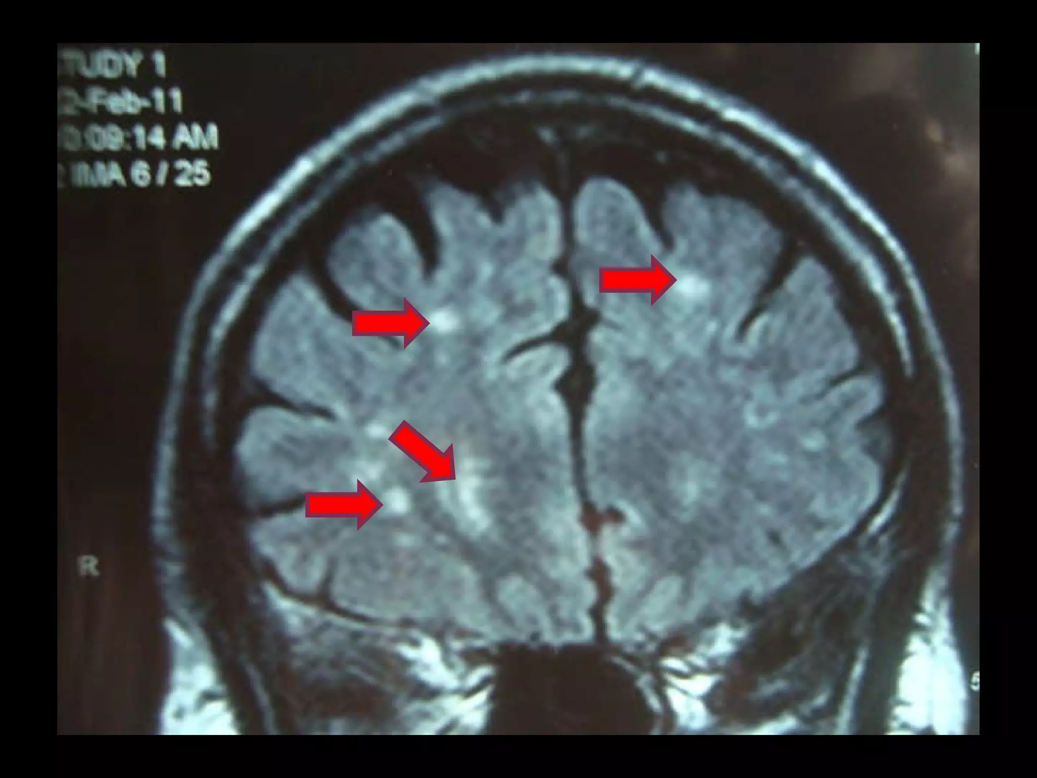 MRI: Leukoaraiosis | PPT