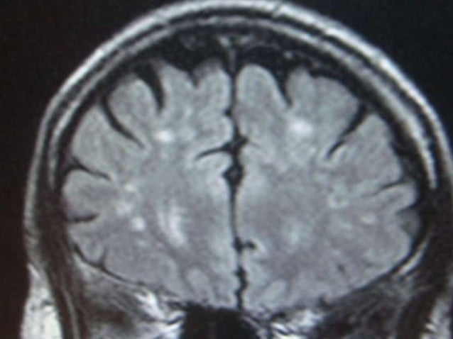 MRI: Leukoaraiosis | PPT