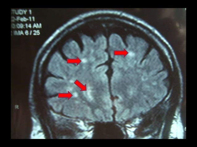 MRI: Leukoaraiosis | PPT