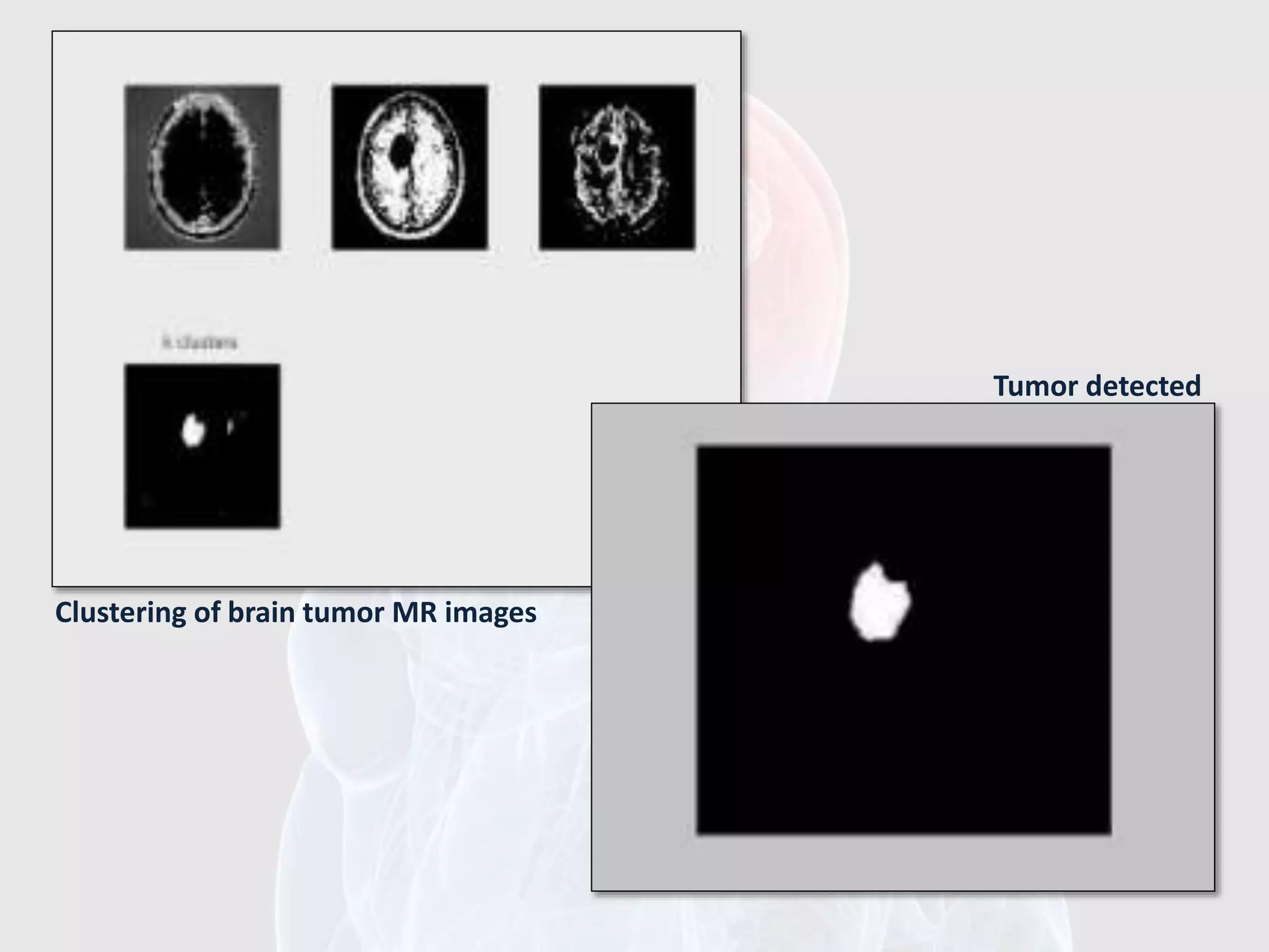 BRAIN TUMOR MRI IMAGE SEGMENTATION AND DETECTION IN IMAGE PROCESSING | PPTX