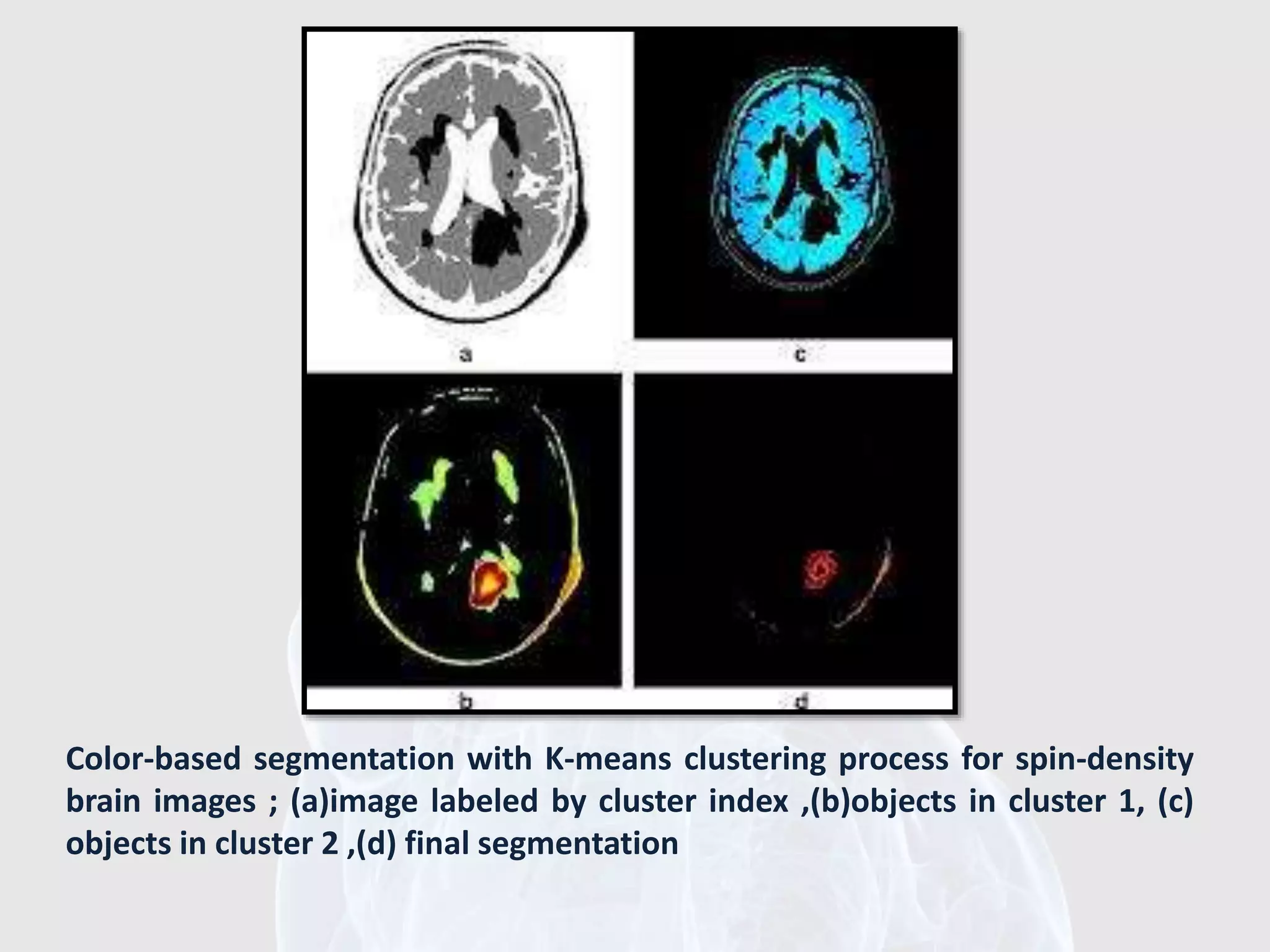 BRAIN TUMOR MRI IMAGE SEGMENTATION AND DETECTION IN IMAGE PROCESSING | PPTX