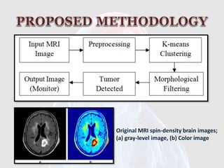 BRAIN TUMOR MRI IMAGE SEGMENTATION AND DETECTION IN IMAGE PROCESSING | PPTX