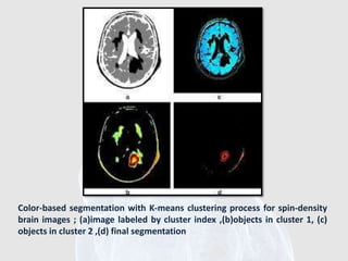 BRAIN TUMOR MRI IMAGE SEGMENTATION AND DETECTION IN IMAGE PROCESSING | PPTX