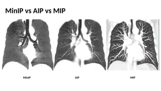 IMAGE REFORMATION TECHNIQUES IN CT-SABBU.pptx | 3-D Graphics | Computer ...