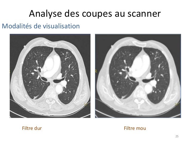 Imagerie scannographique du thorax