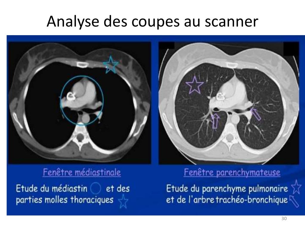 Imagerie scannographique du thorax