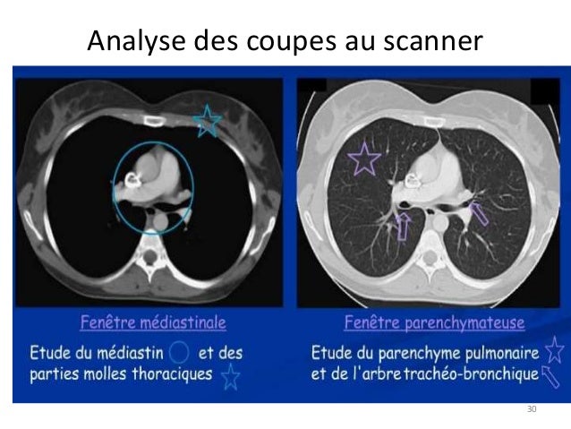 Imagerie scannographique du thorax