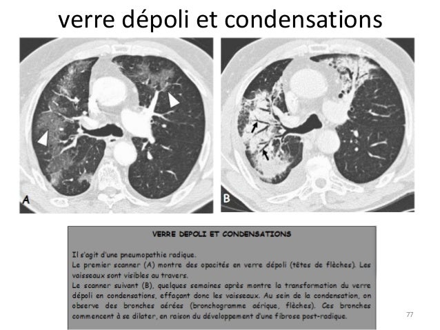 Imagerie scannographique du thorax