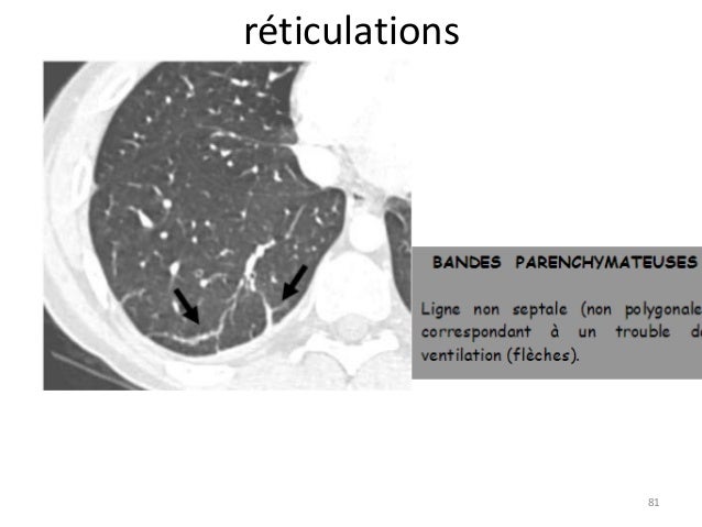 Imagerie scannographique du thorax