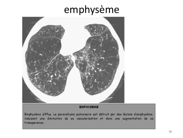 Imagerie scannographique du thorax