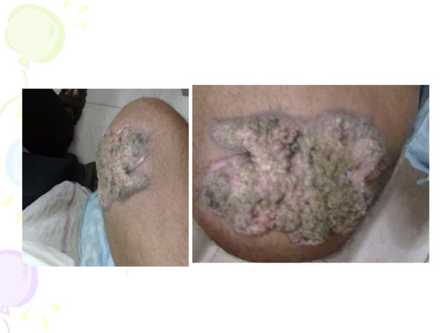 Images: Lupus Vulgaris ... VHL Syndrome | PPT