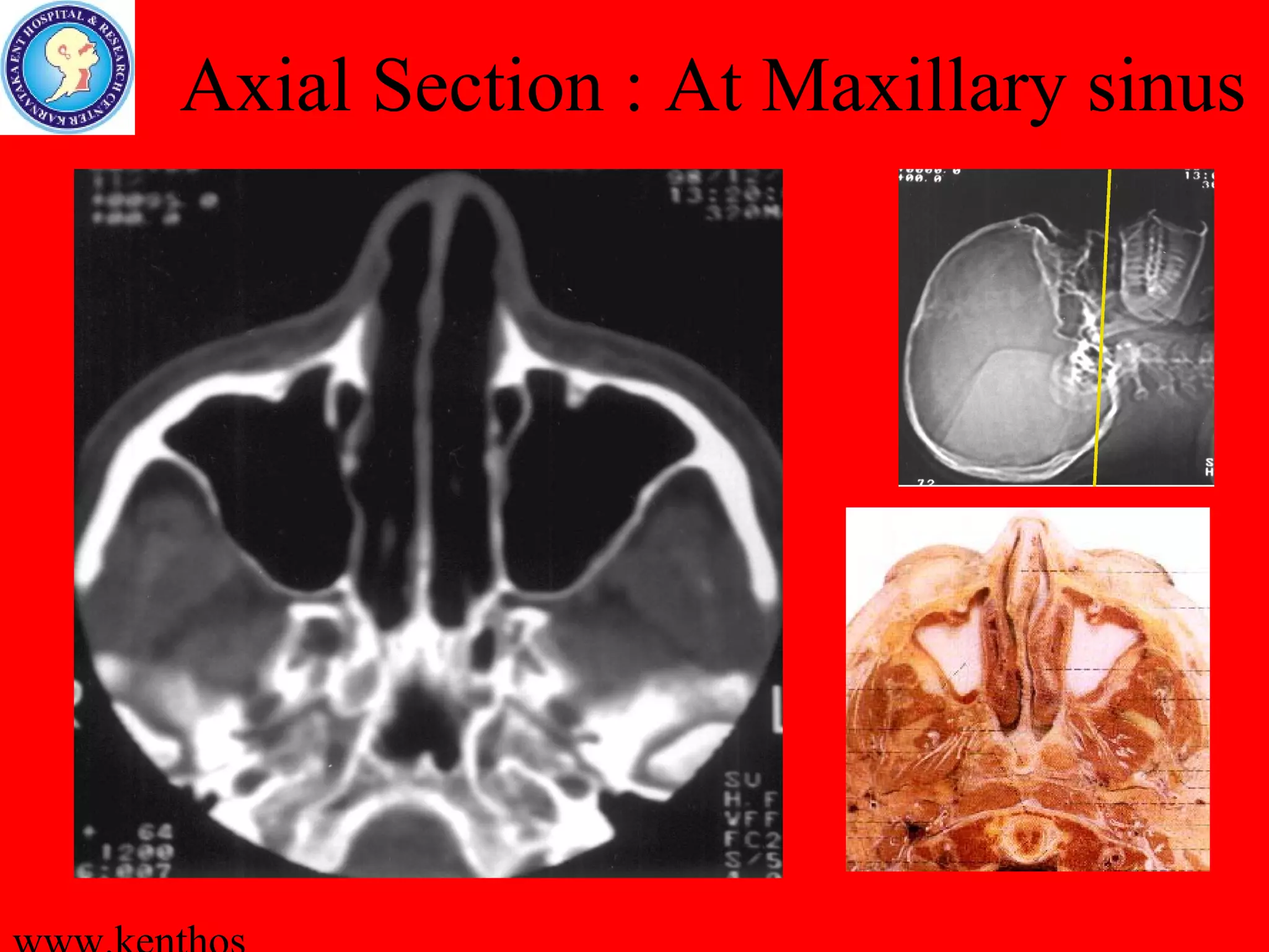 Imaging for Endoscopic Sinus Surgery | PPS