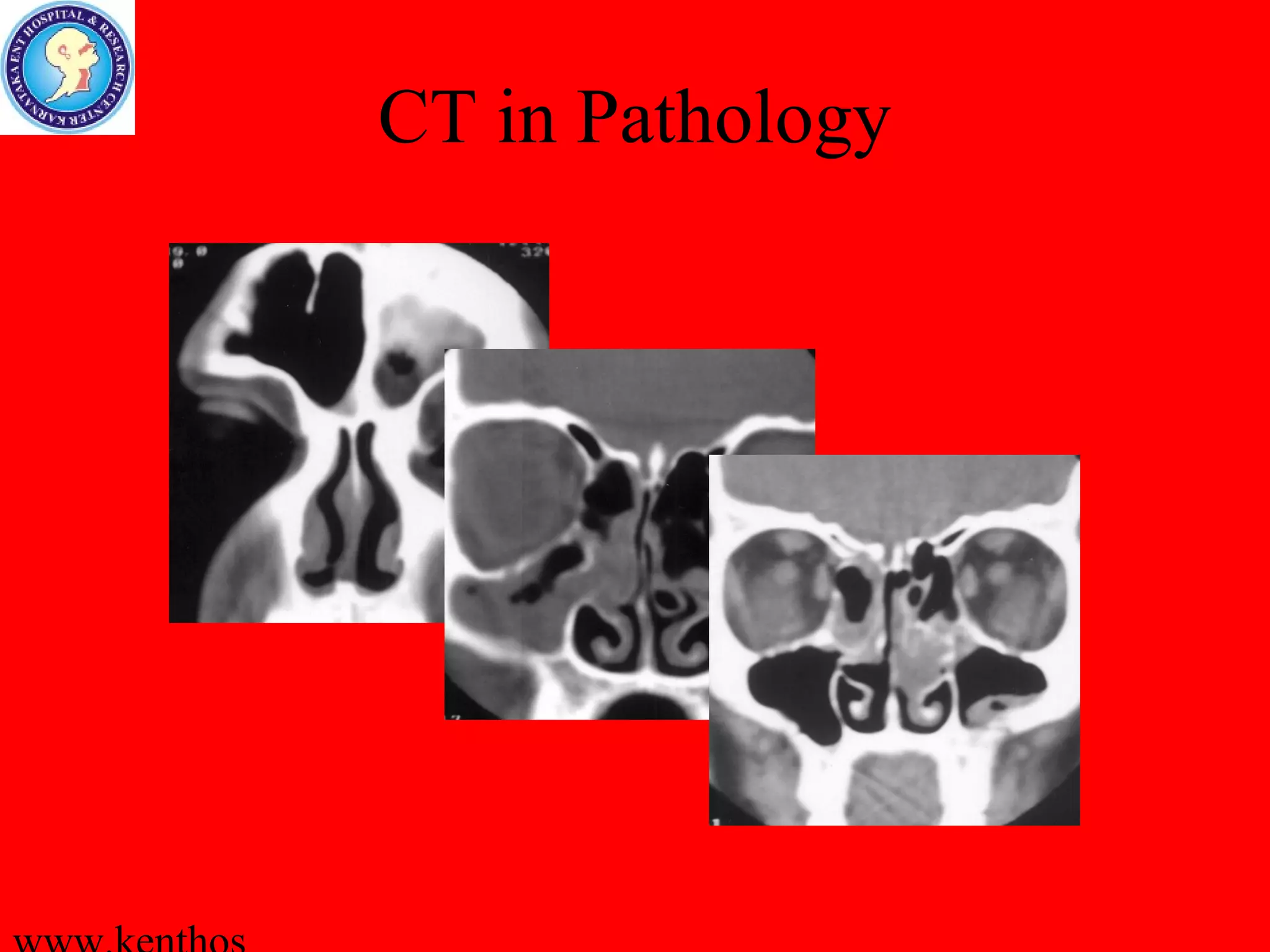 Imaging for Endoscopic Sinus Surgery | PPS