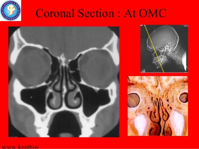 Imaging for Endoscopic Sinus Surgery