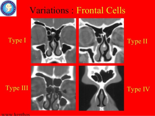 Imaging for Endoscopic Sinus Surgery