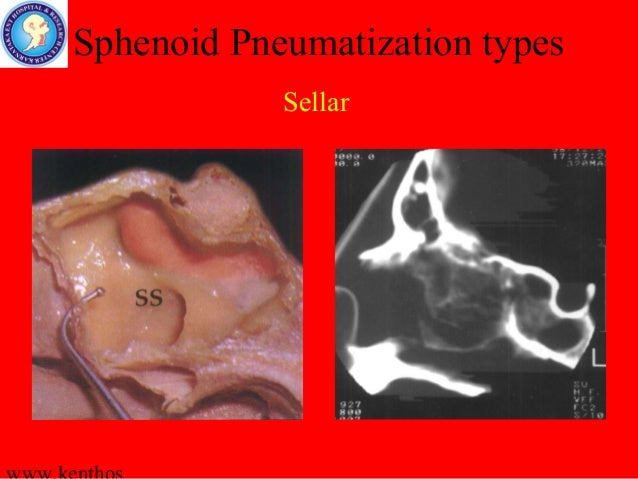 Imaging for Endoscopic Sinus Surgery