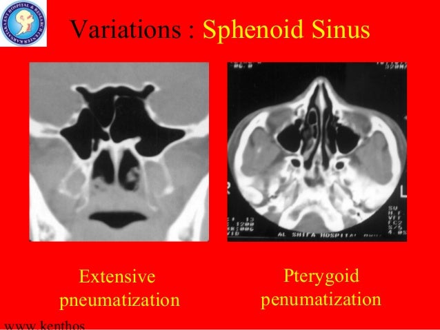 Imaging for Endoscopic Sinus Surgery