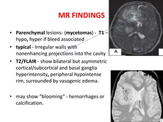 Imaging cnsfunfalinfections-170112061313 | PPTX