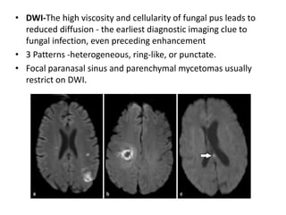 Imaging cnsfunfalinfections-170112061313 | PPTX | Blood Disorders ...