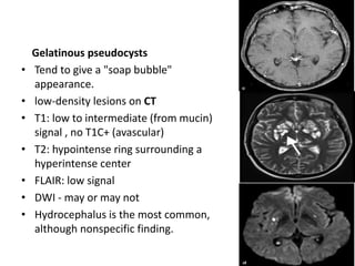 Soap Bubble Lesions Cryptococcus Neoformans In Brain