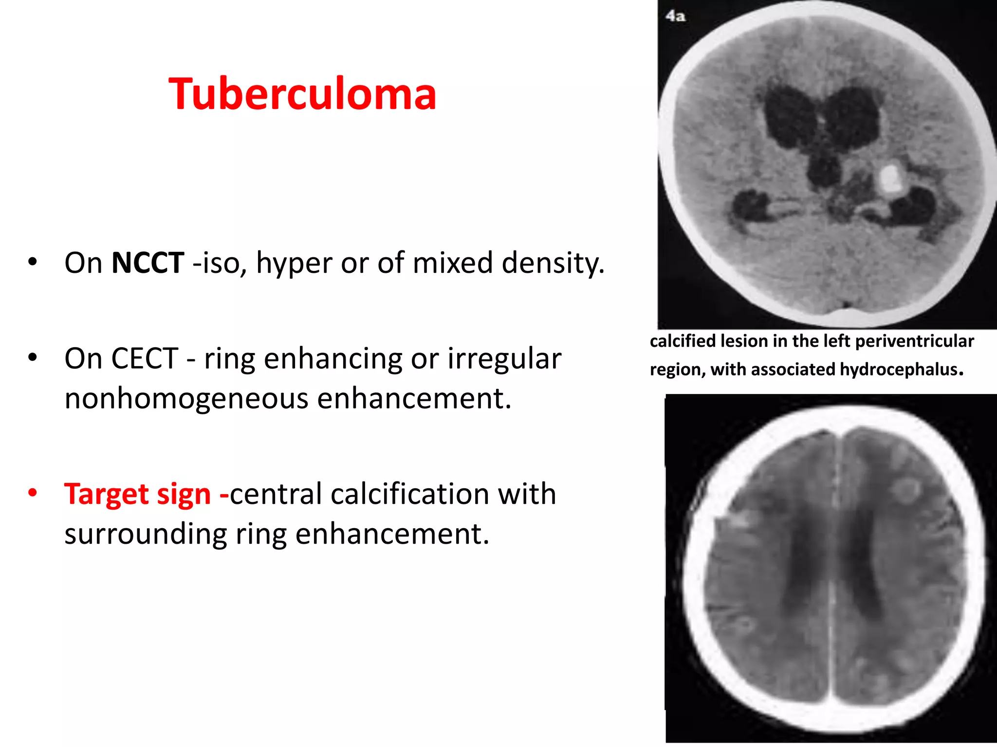 Imaging cns tb | PPTX