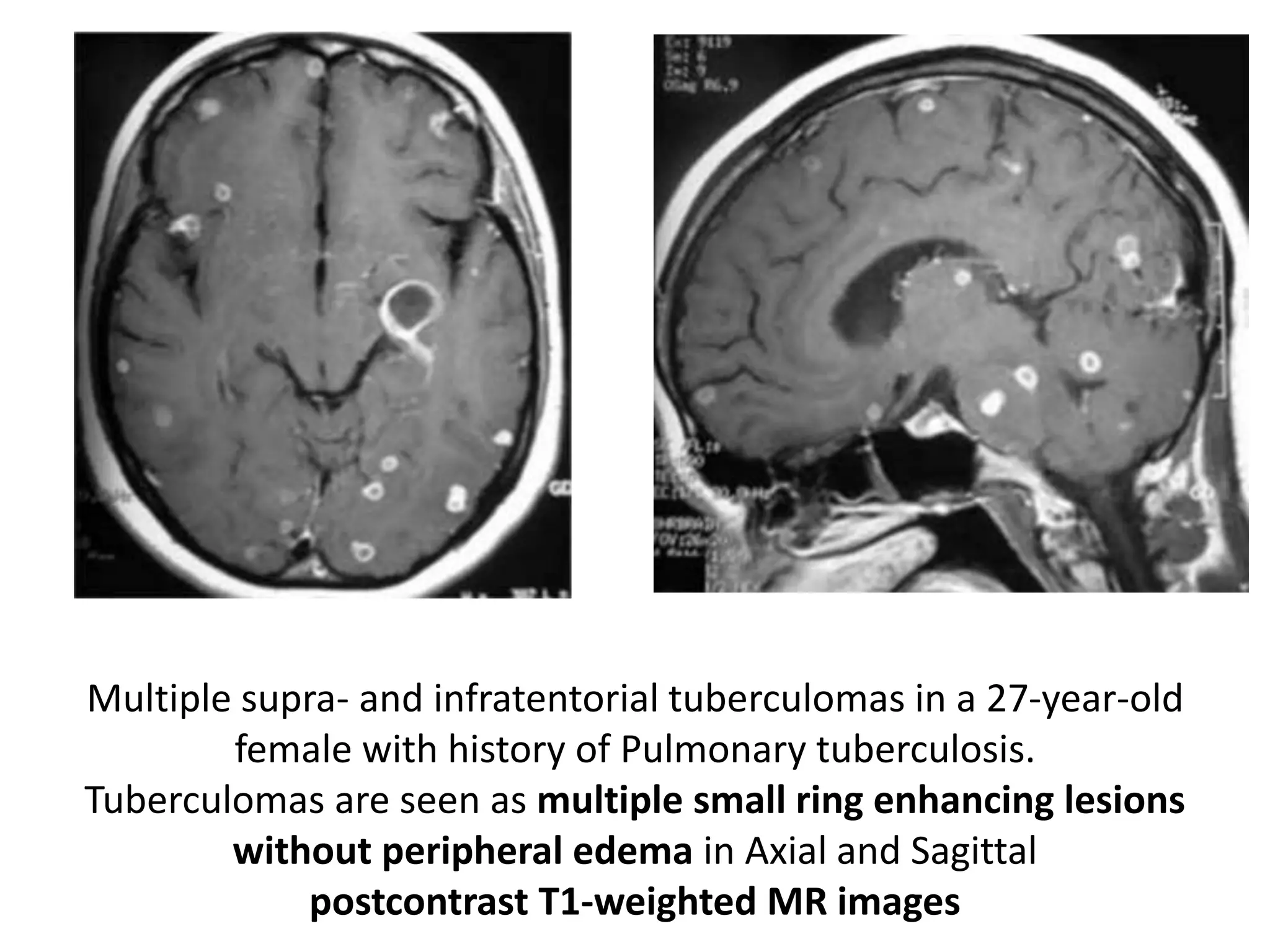 Imaging cns tb | PPTX