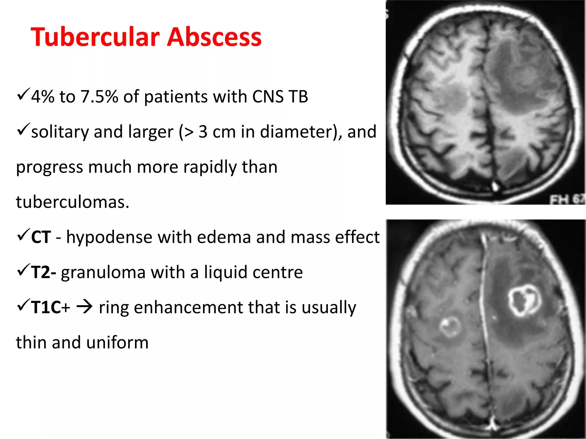 Imaging cns tb | PPTX