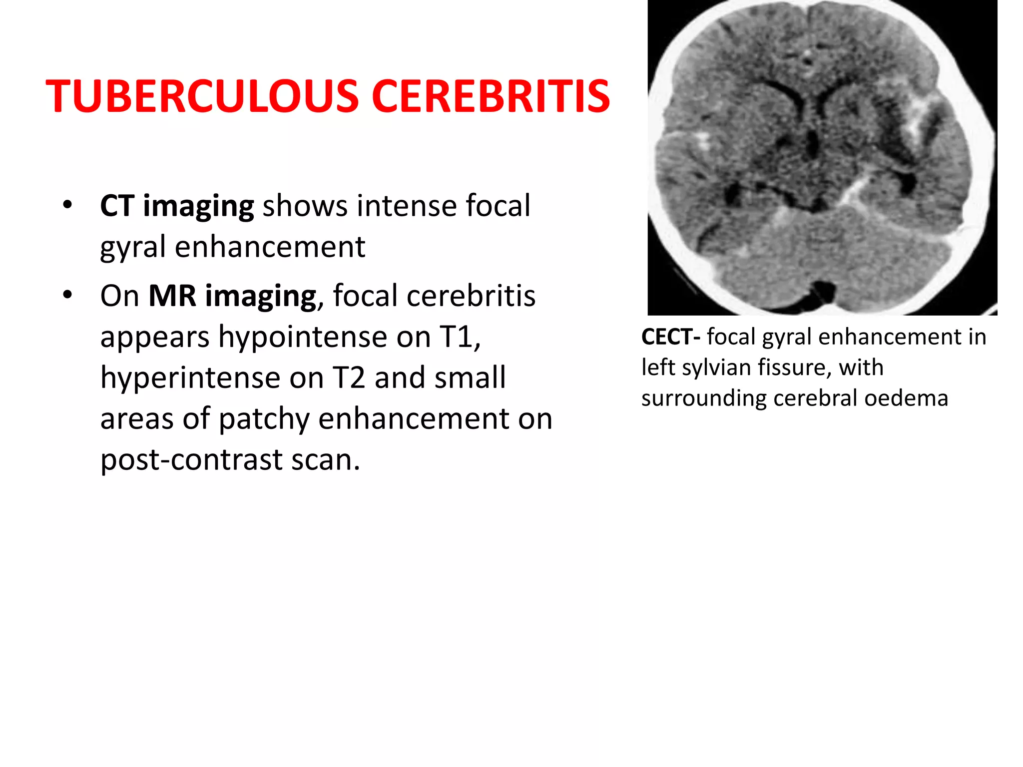 Imaging cns tb | PPTX