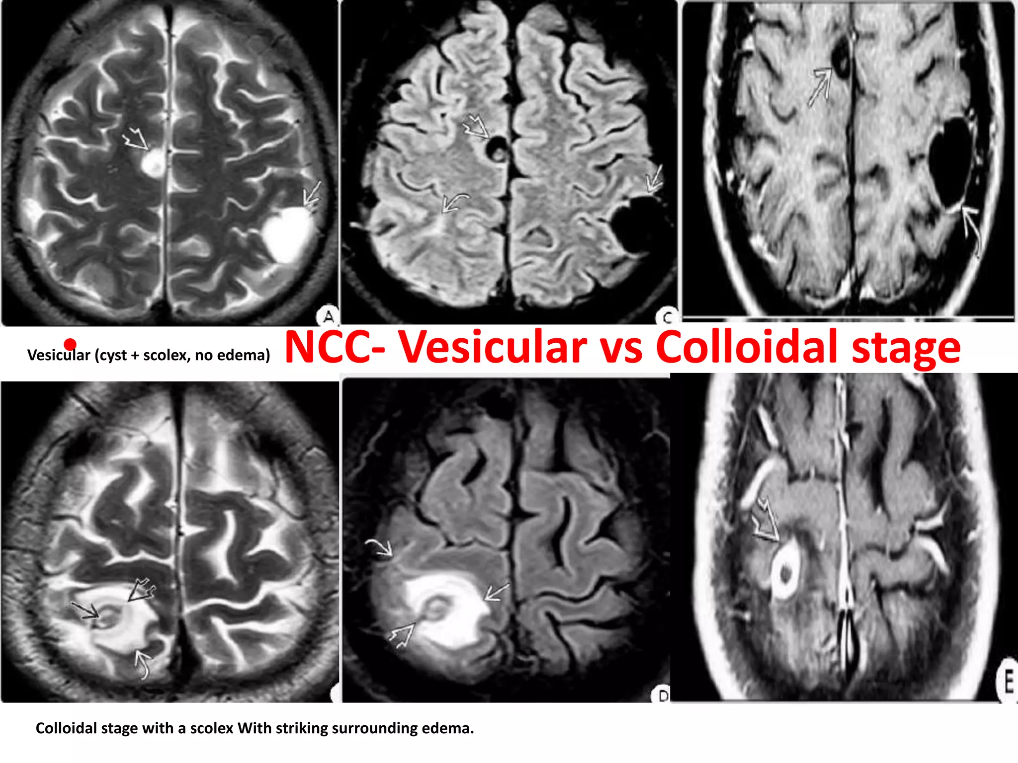 Imaging cns tb | PPTX
