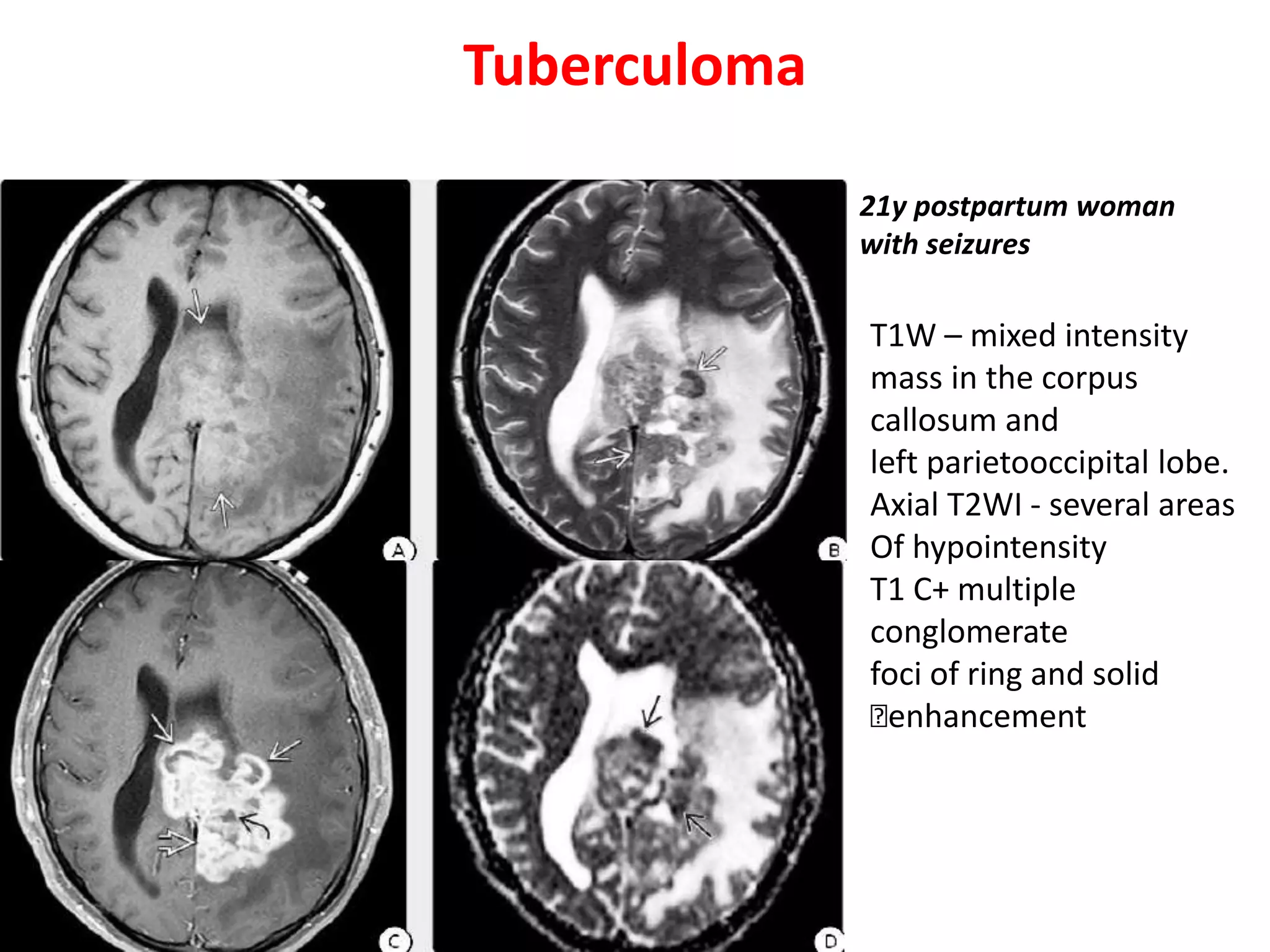 Imaging cns tb | PPTX