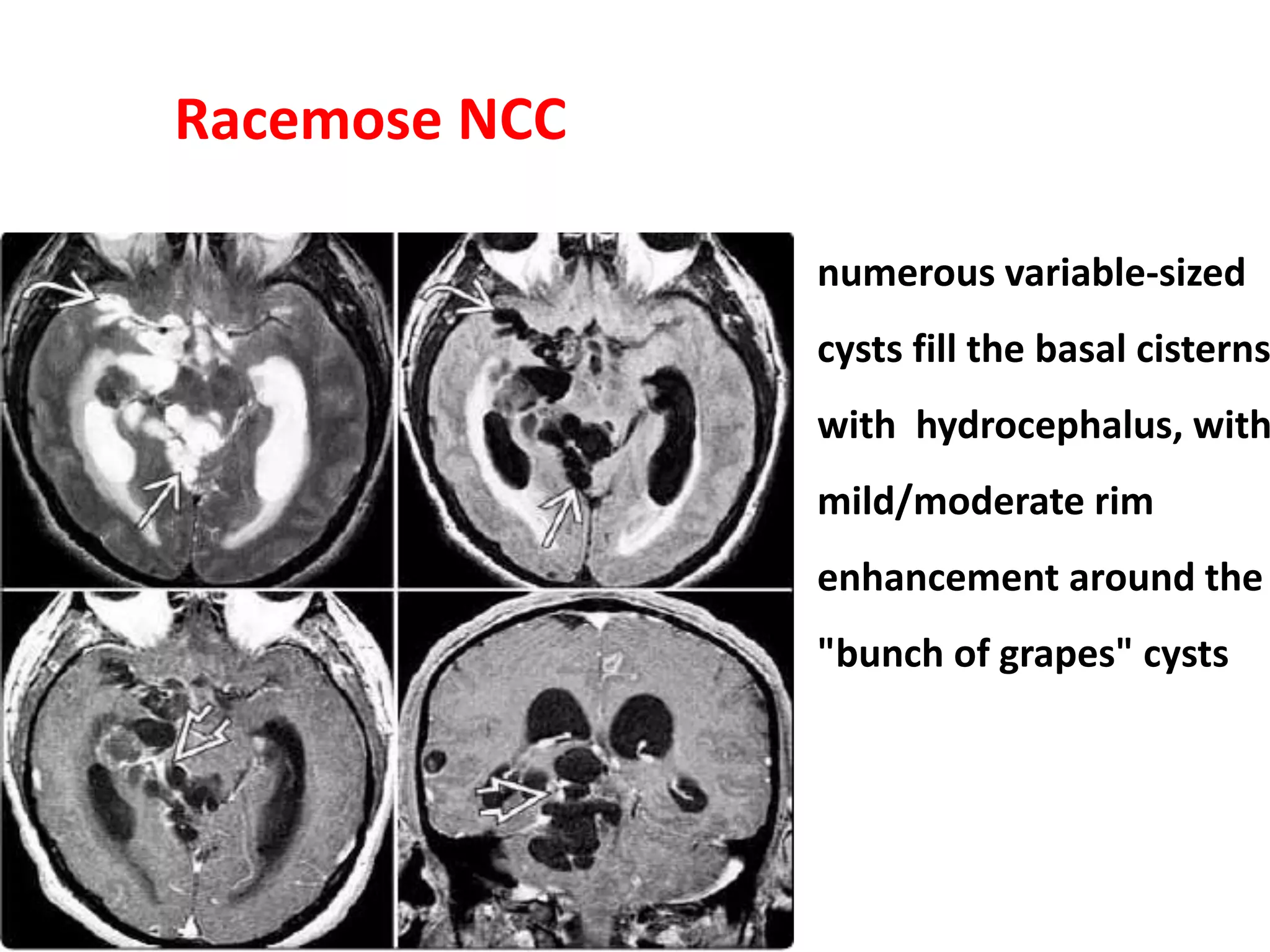 Imaging cns tb | PPTX
