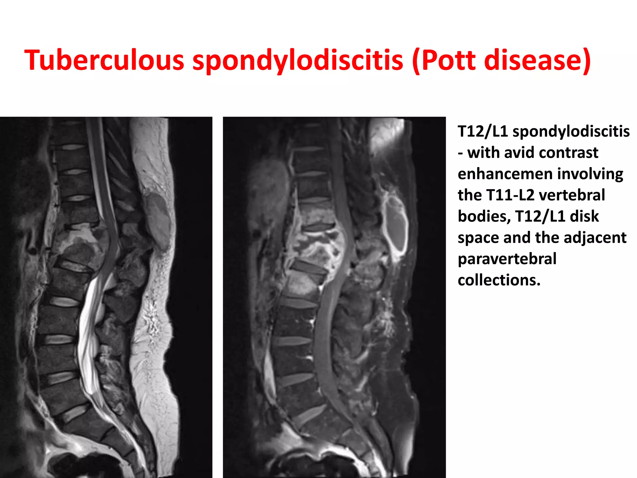Imaging cns tb | PPTX