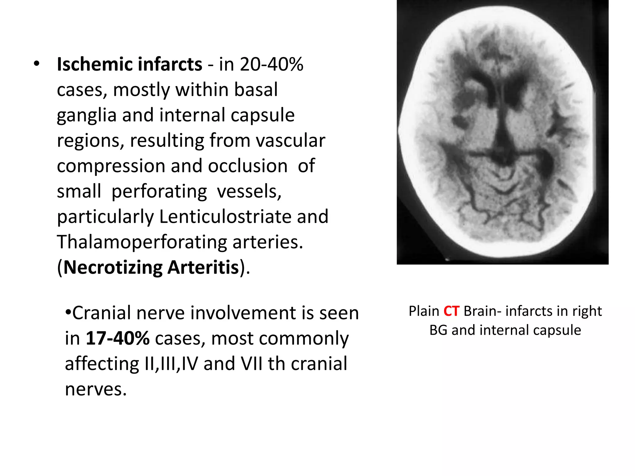 Imaging cns tb | PPTX